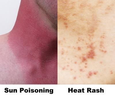 Summer hazards: From heat rash to heat stroke | Columns | keysnews.com