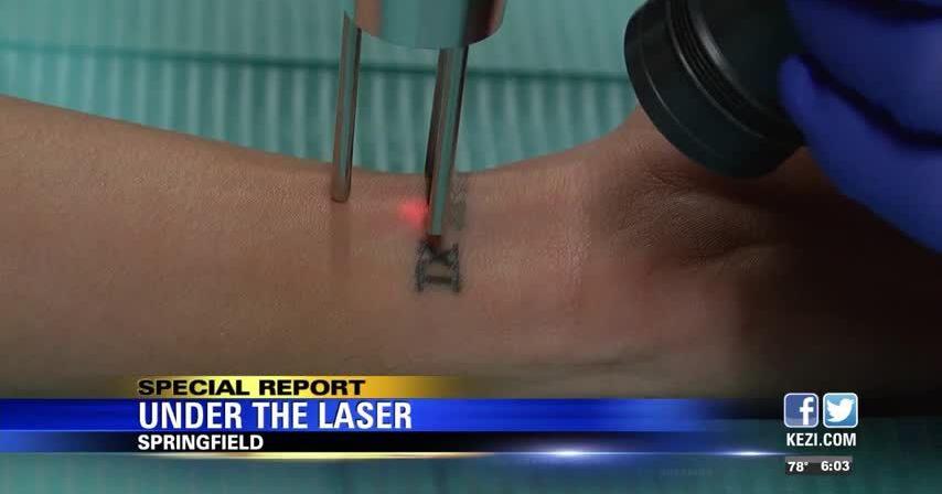 Laser tattoo removal erasing the past at Springfield shop | Features ...