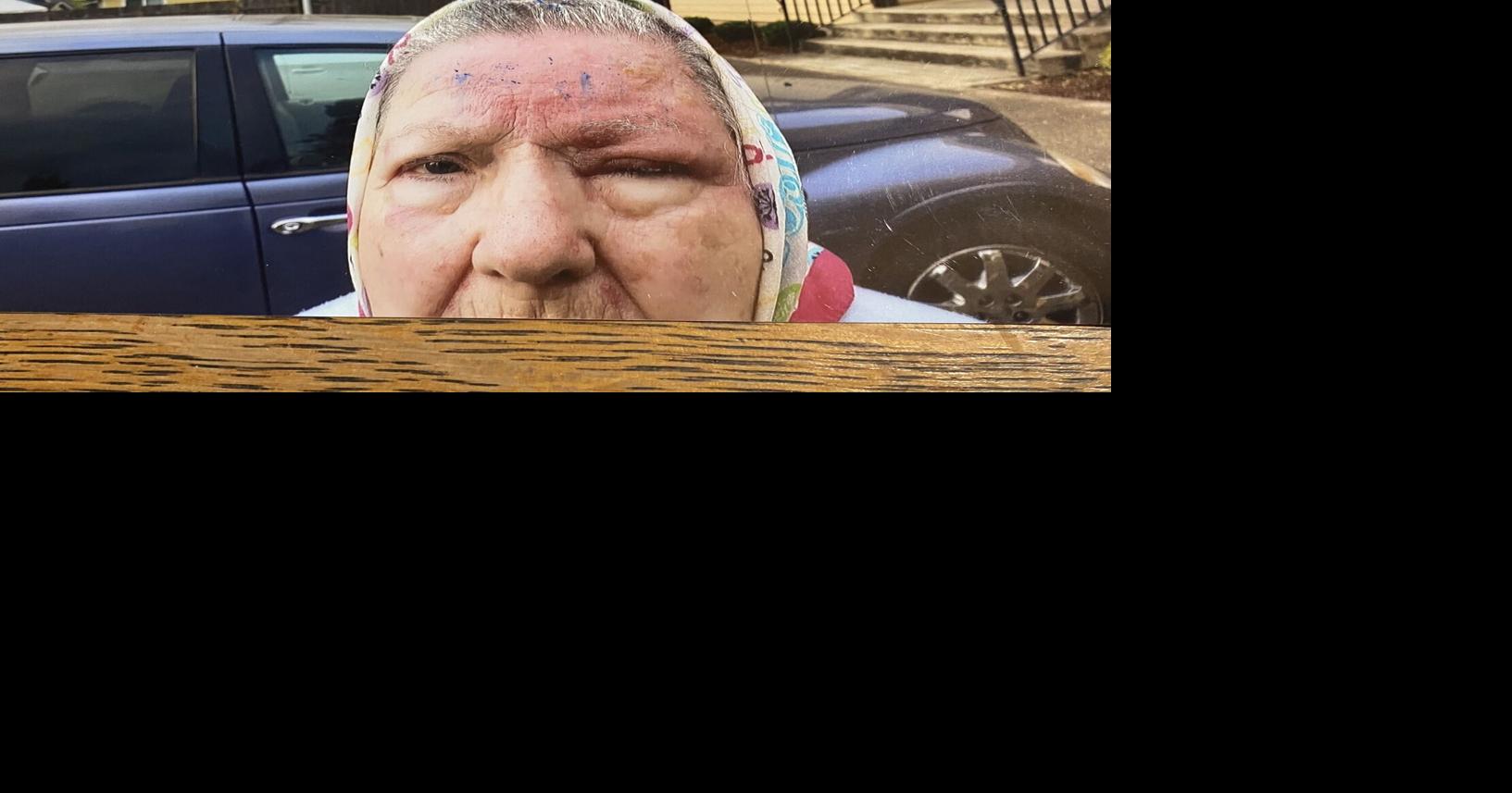 84-year old Springfield woman says she got radiation burns from a ...