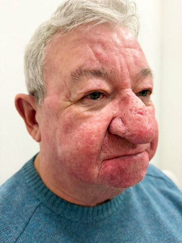 Man undergoes life-changing surgery for massive nose growth | Health ...
