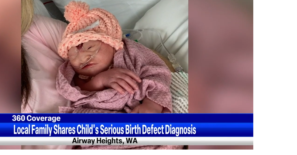 Airway Heights family shares child's serious birth defect diagnosis of ...