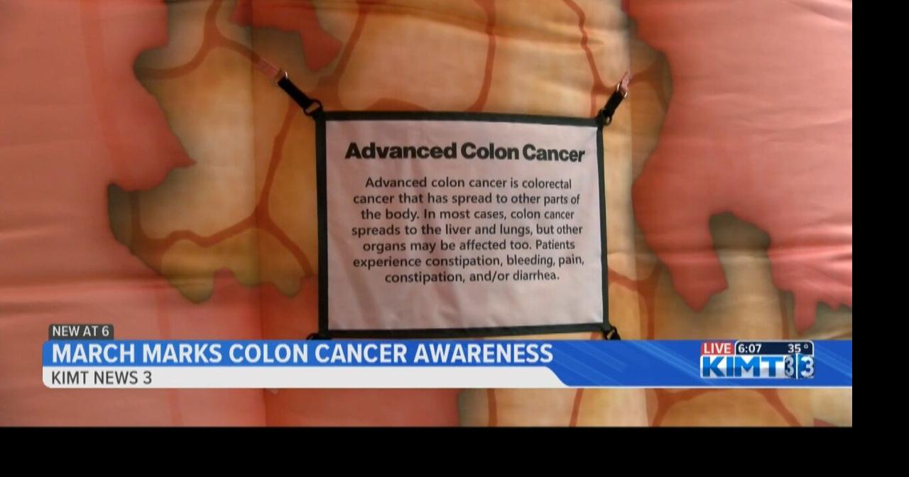 March is Colon Cancer Awareness Month | Health | kimt.com