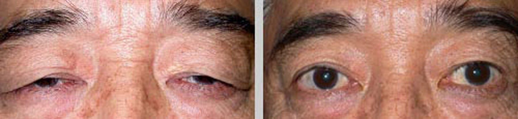 Aging Well: Ptosis or droopy eyes can obstruct vision | Aging Well ...