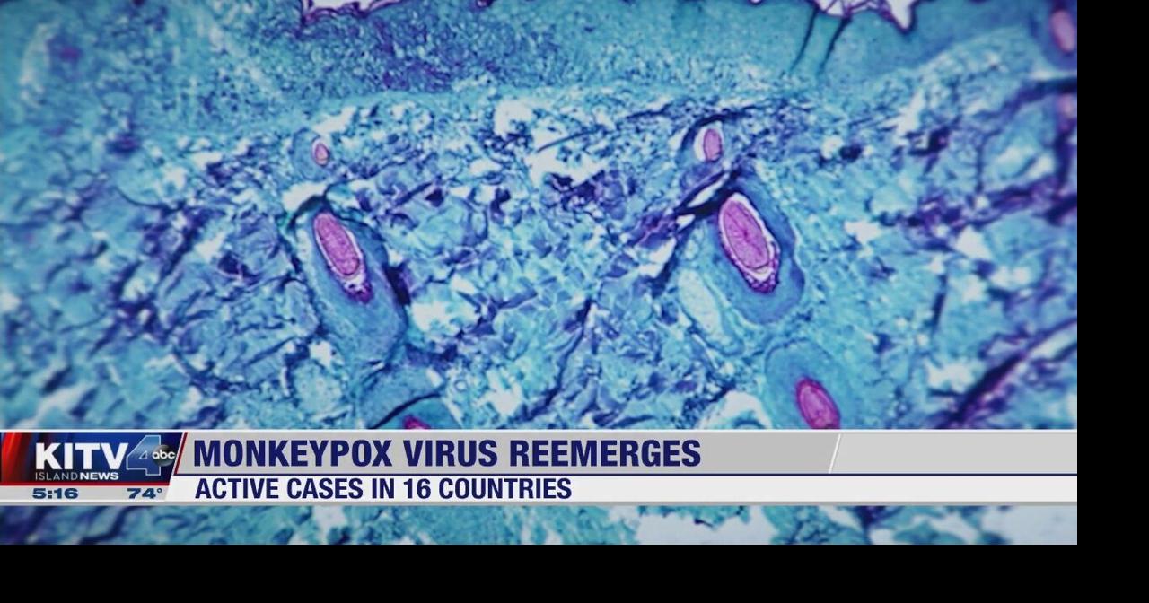 Monkeypox: Identifying cases, signs and symptoms | Local | kitv.com