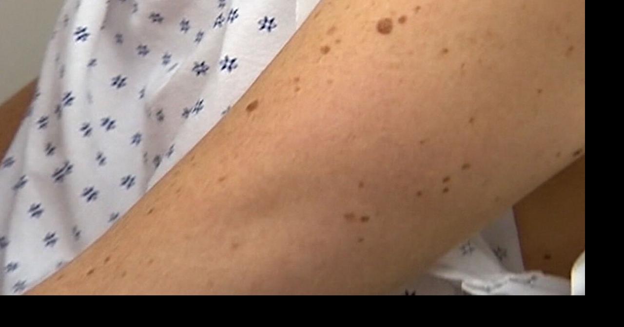 Skin cancer cases up 14% in Hawaii, according to new study | Local ...