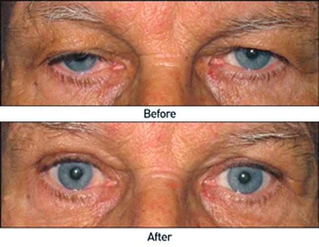 Aging Well: Ptosis or droopy eyes can obstruct vision | Aging Well ...