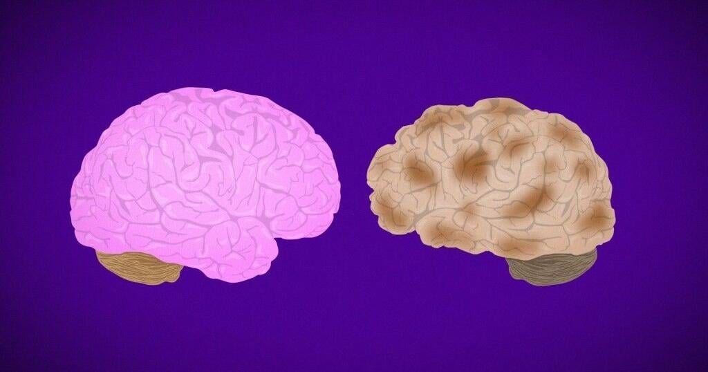 Lifestyle changes improve cognition in people at risk for Alzheimer’s ...