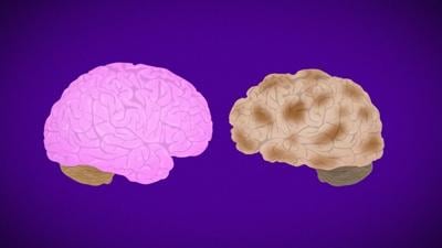 Lifestyle changes improve cognition in people at risk for Alzheimer’s ...