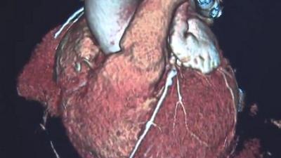 ‘Holiday heart syndrome’: What is it and how to avoid it | Health ...