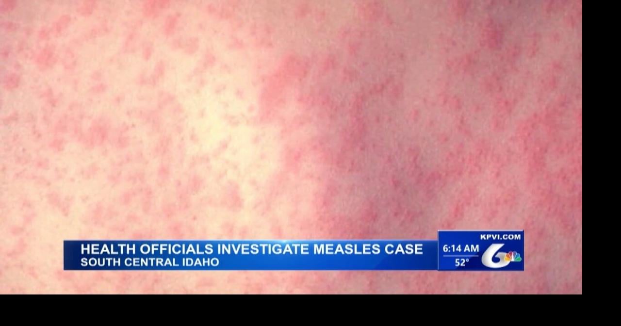 A Measles Case in Idaho is Being Investigated | Local News | kpvi.com