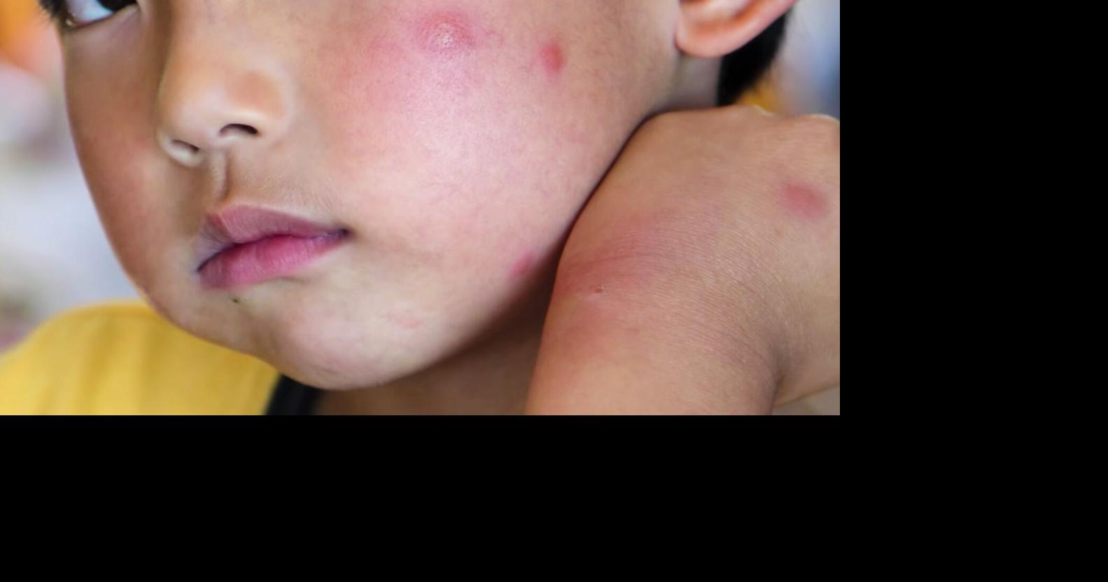 Skeeter syndrome: Mosquito bites can cause severe reactions | Health ...