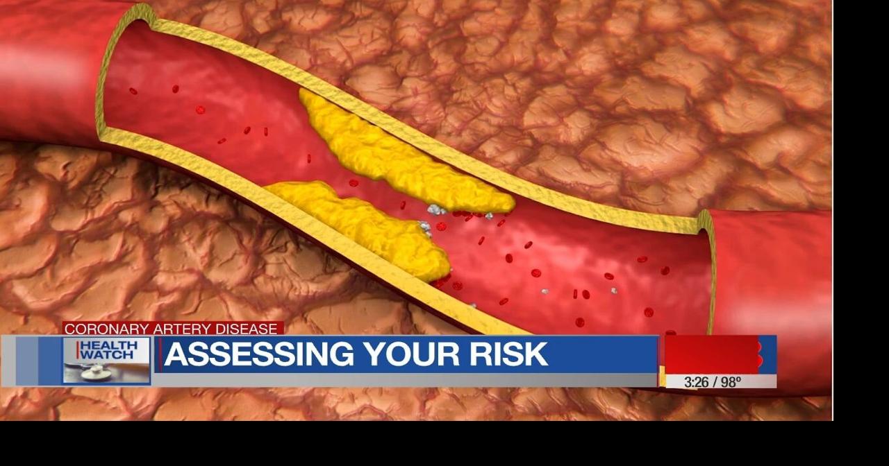 Coronary Calcium Score: A Key Indicator in Assessing Coronary Artery ...