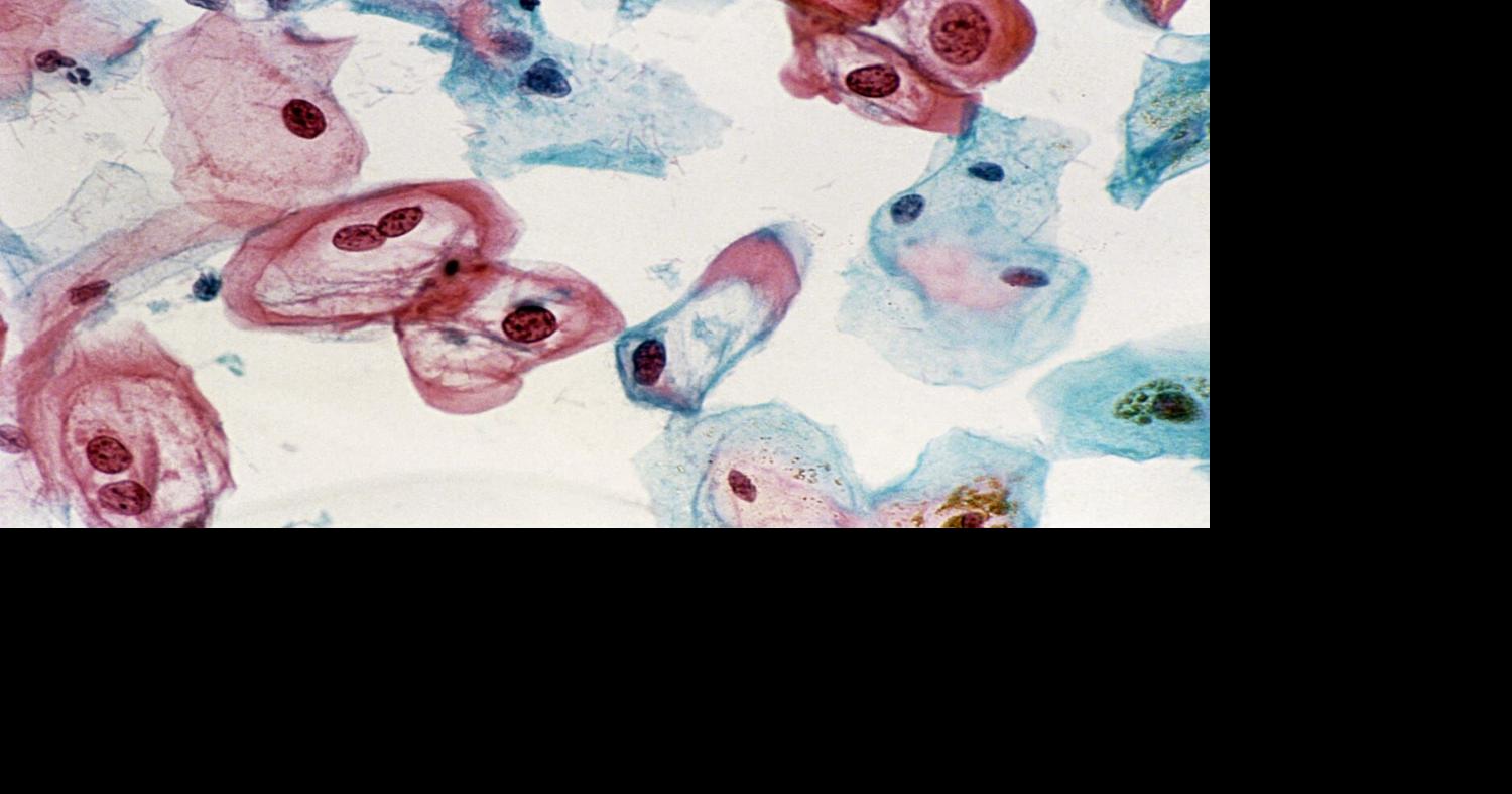 Should you continue pap smear screening after having a hysterectomy ...