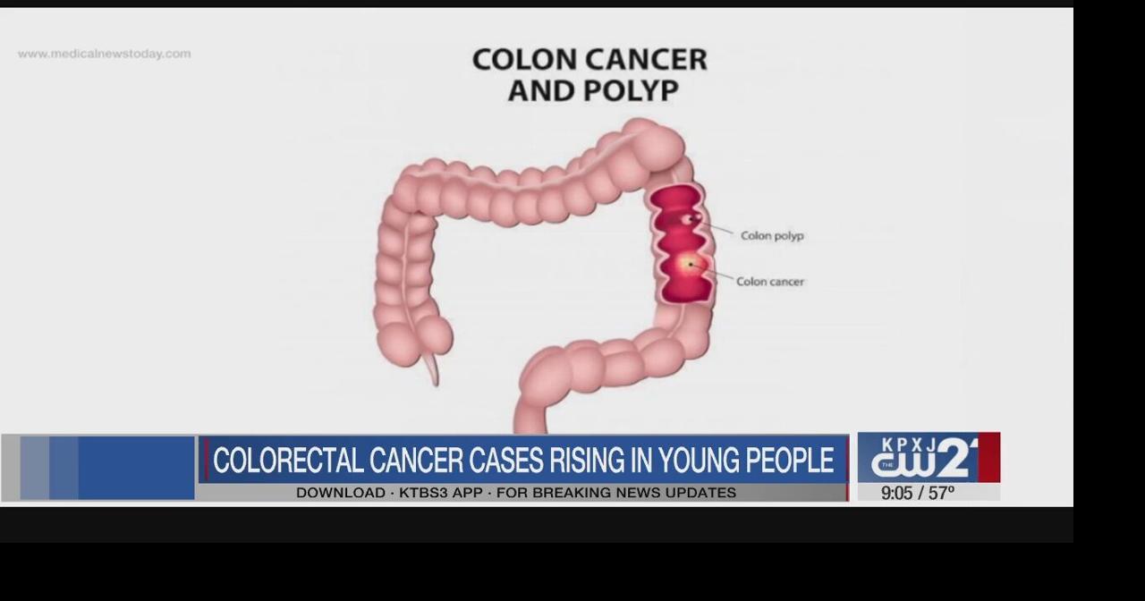 Colorectal cancer cases rising rapidly in young people | News | ktbs.com