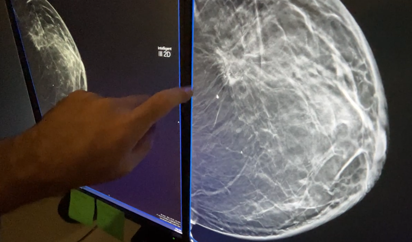 KTBS 3 viewers get help from experts on breast health | Breast Cancer ...