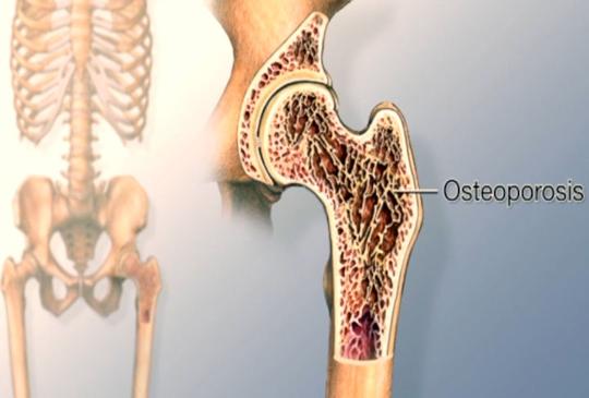Is Tymlos the new osteoporosis miracle drug? | News | ktbs.com
