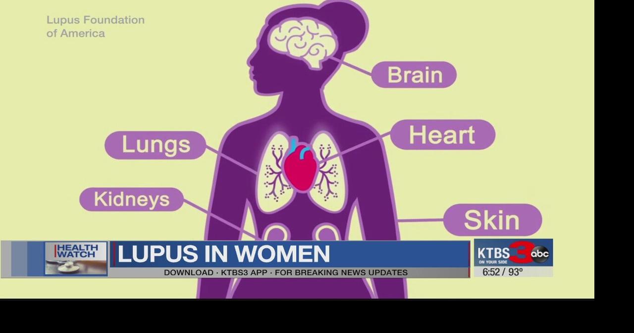 Most cases of lupus are in women; newer treatments are more precise ...
