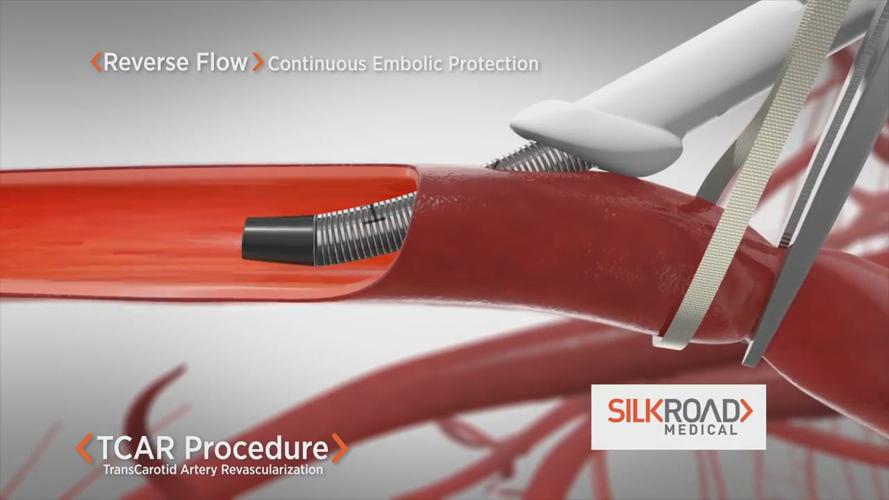 Woman survives what could have been deadly TIA | ArkLaTex In-Depth ...