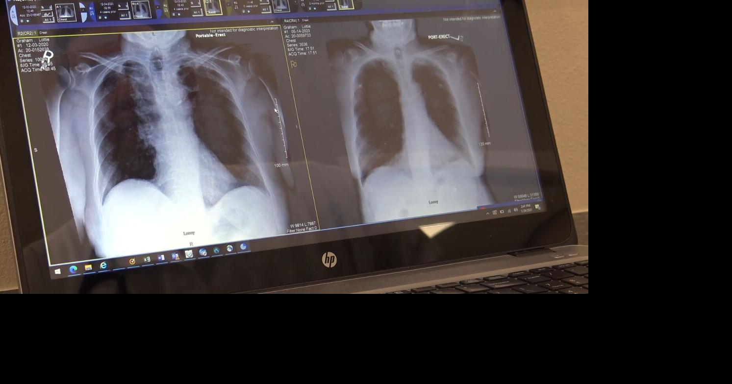 Valve surgery gives COPD, emphysema sufferers hope | Health | ktbs.com