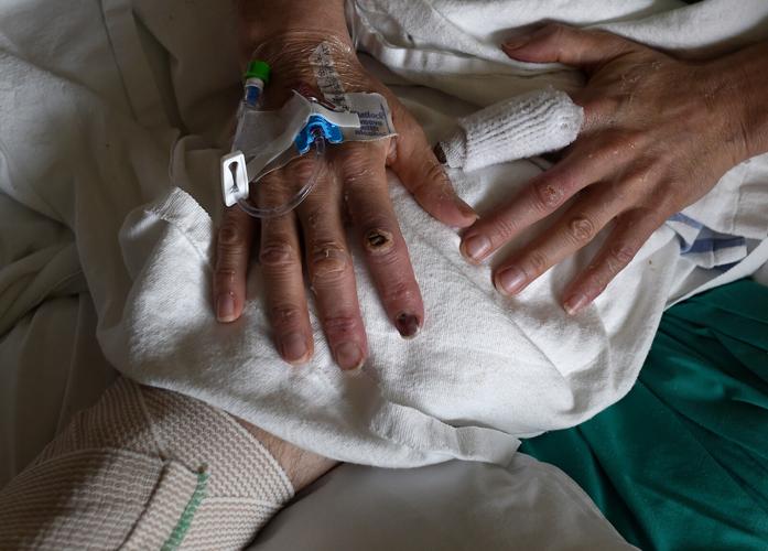 Frostbite can strike quickly. Here’s what you need to know | Health ...