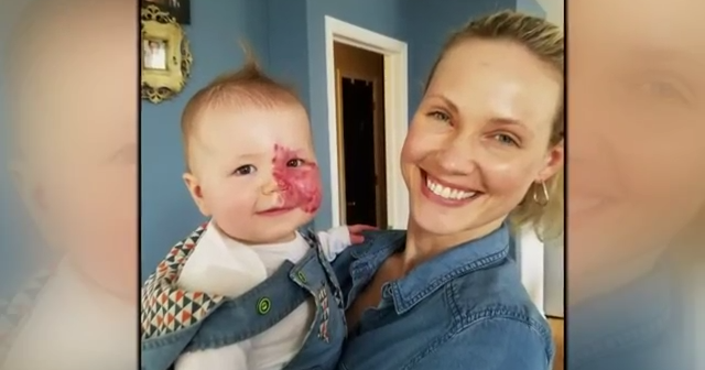 Elizabeth Klinge shares her daughter's Vascular Birthmark diagnosis ...