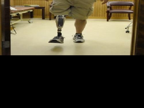 High-tech artificial limb has amputee on move once again | News ...