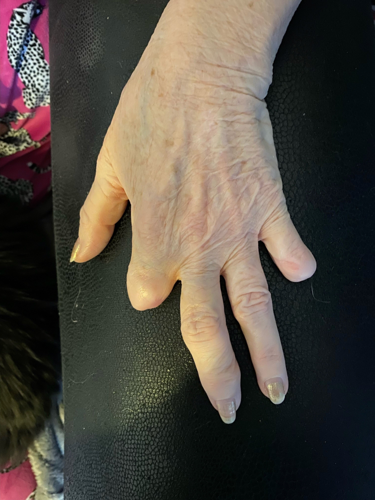 Grandma loses fingers and toes to sepsis after botched diagnosis ...