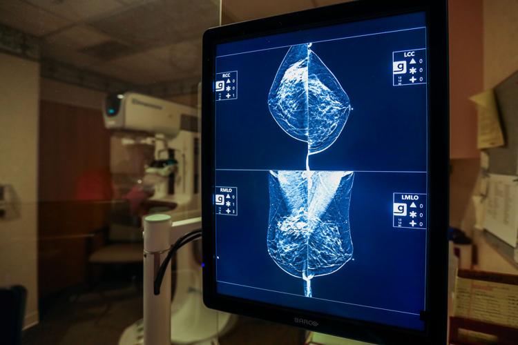 Marshall Health Network hospitals uses AI to read mammograms | Special ...