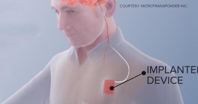 Stroke rehab study using nerve stimulation to rewire patient's brain ...