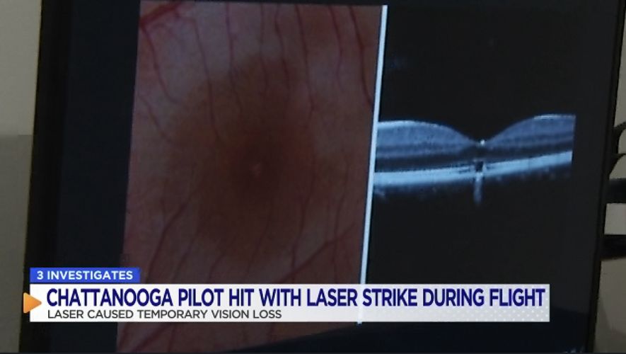Chattanooga pilot says laser strike impaired his co-pilot's vision ...