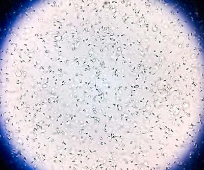 Sperm donor with rare genetic mutation fathered 67 children. Ten now ...