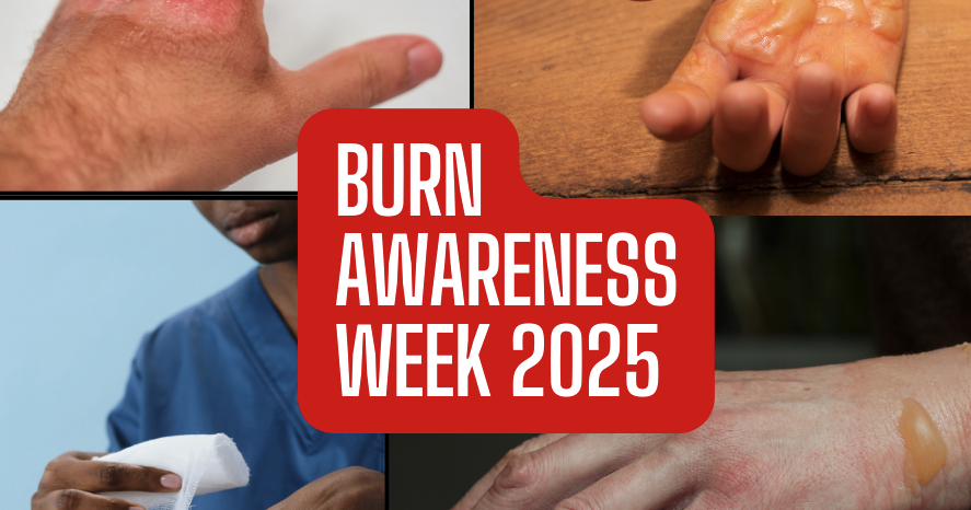 Importance of National Burn Awareness Week | Local News | local3news.com