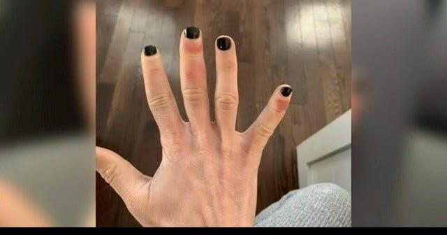 'COVID toes and fingers' appear after some have mild cases of ...