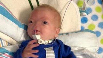 born without a nose