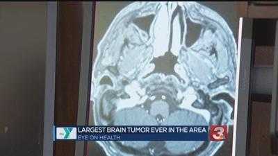 Local doctors say it's the largest brain tumor they've ever seen | Eye ...