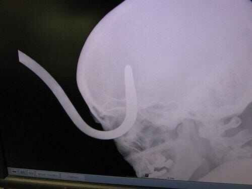 Impaled: woman recalls when steel hook pierced her brain | | local3news.com
