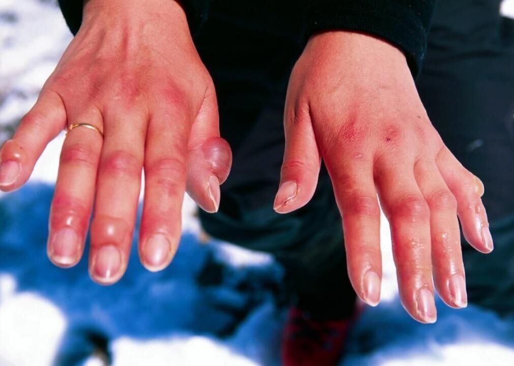 Limit time outside, take breaks to avoid frostbite