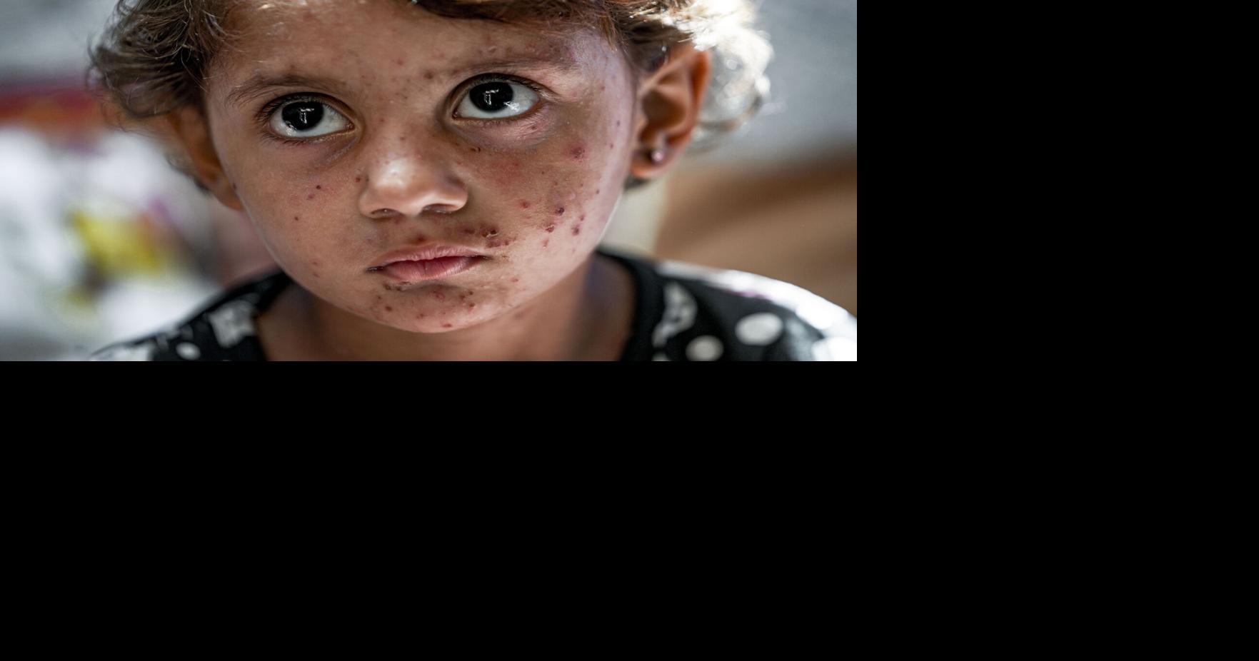 Lice, scabies, rashes plague Palestinian children as skin disease runs ...