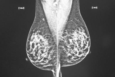 More breast cancer patients can choose smaller surgery | Highlands News ...