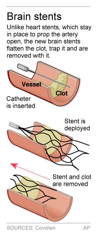 STROKE BRAIN STENT | Latest Headlines | morganton.com