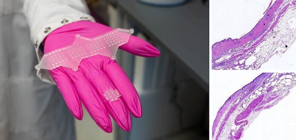 ‘Living bandage’ acelerates healing of wounds | Health | msuexponent.com