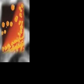 New Super Bug CRE is Nearly Impossible to Treat | Healthalert ...