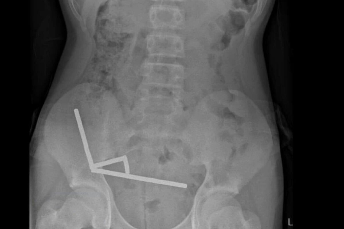 Teen Loses Part of Bowel After Swallowing 80+ Magnets | Health | nbcrightnow.com