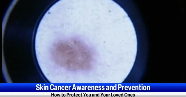 How to identify skin cancer and why it's important to get treated early ...