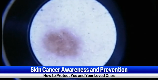 How to identify skin cancer and why it's important to get treated early ...