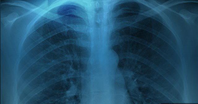 A Washington woman with tuberculosis refuses treatment, so authorities ...