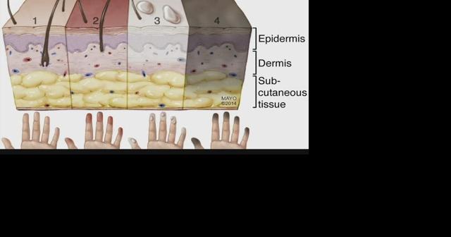 frostbite 3rd degree