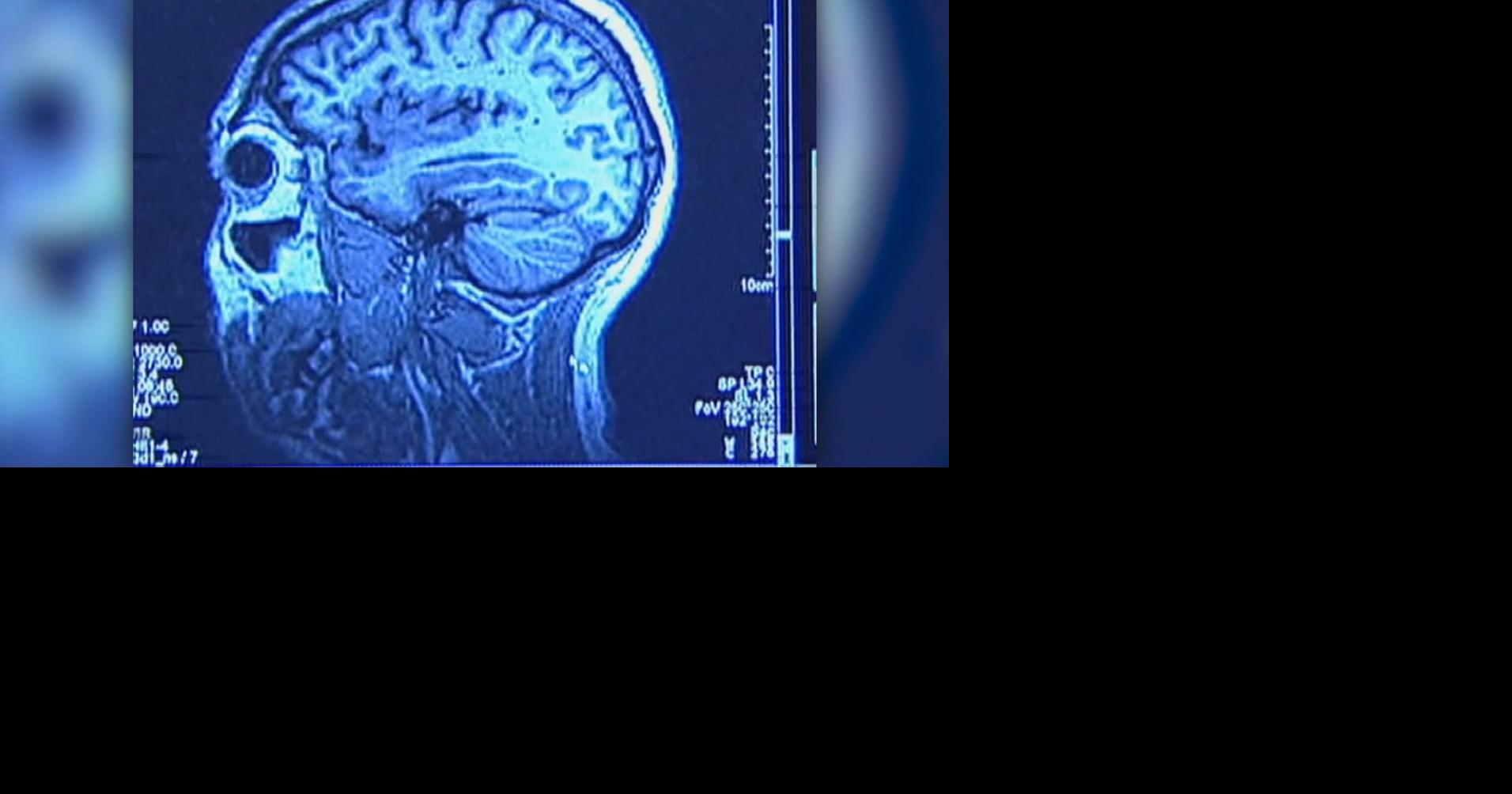 New study finds early signs of CTE in young athletes | Health ...