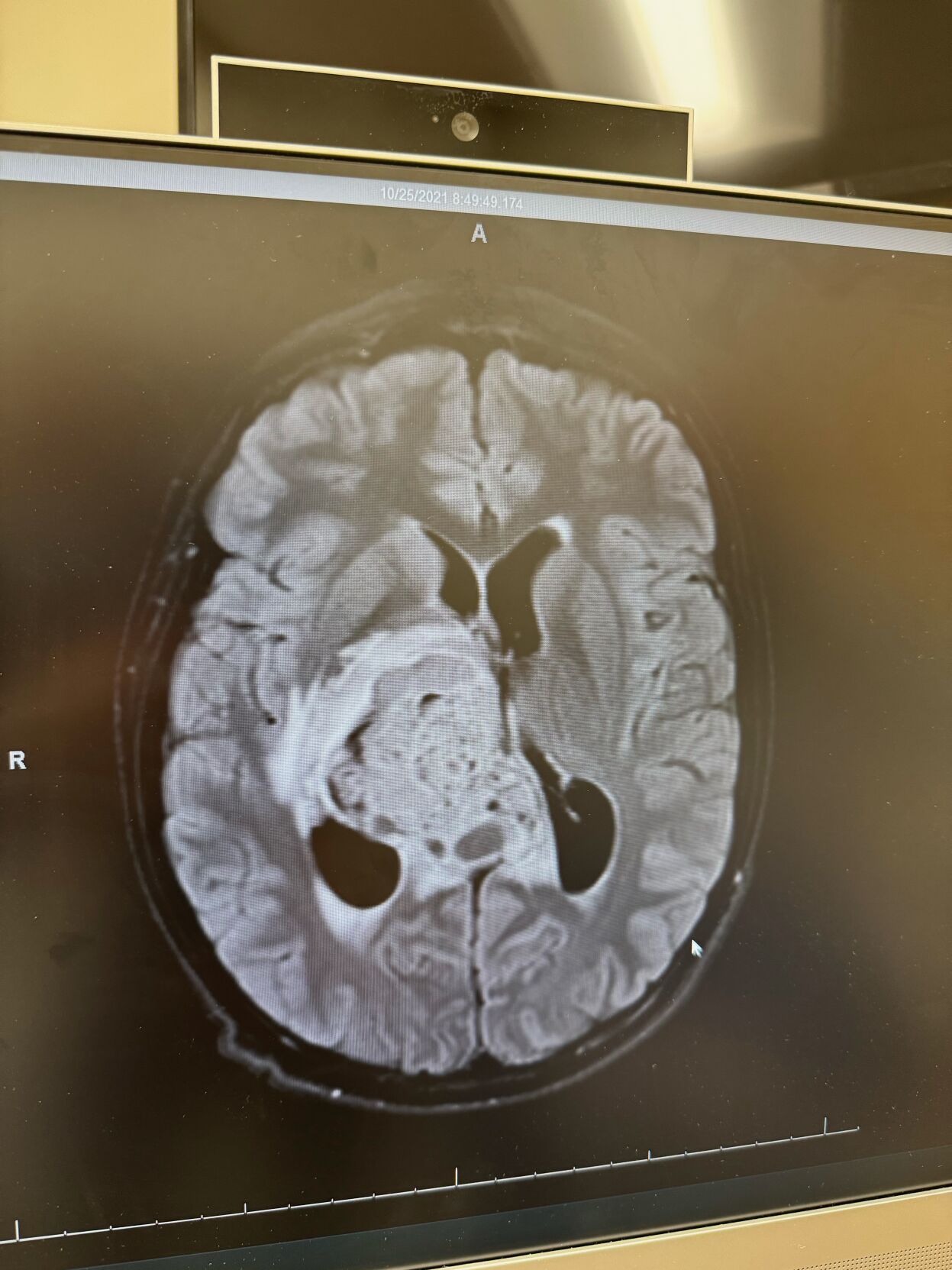 One day at a time: Adin Sindelar's brain cancer recovery journey as a ...