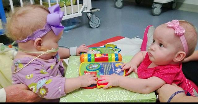 Formerly conjoined Adams twins introduced to the world | News | nny360.com